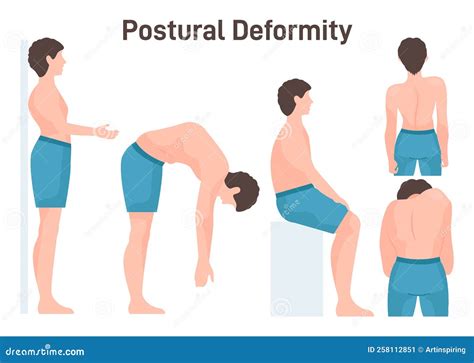 Postural Deformity Scoliosis Curvature Illness Of Spine Stock Vector