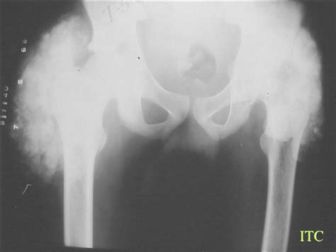 Ppt Soft Tissue Calcification And Ossification Powerpoint Presentation Id 1231405
