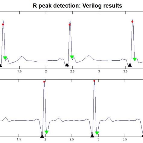 qrs complex detection download scientific diagram