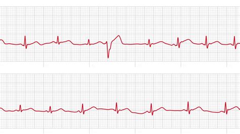 My First Pvc Recording With Compensatory Pause Not Looking For Advice R Applewatch