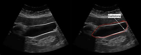 Abdominal Diagram Quadrant At Lea Warren Blog