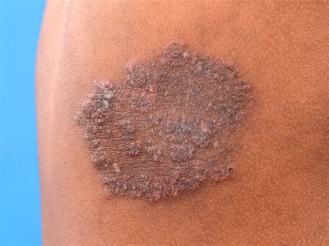Ringworm Tinea Corporis Patientenfolder