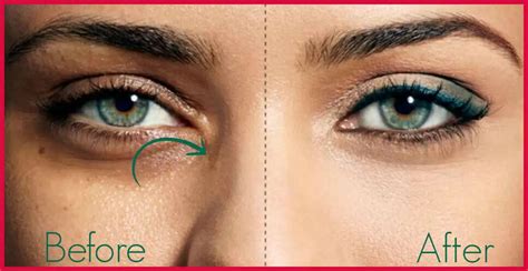Say Goodbye To Spectacle Marks 5 Tips For Avoiding Nose Indentations
