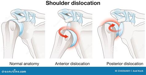 Shoulder Dislocation Anterior Dislocation Posterior Dislocation