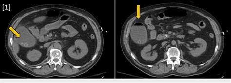 Ct Abdomen And Pelvis Without Contrast Showing A Distended Gallbladder