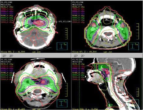 The Calculated Dose Distribution Using The Monte Carlo Method Download Scientific Diagram