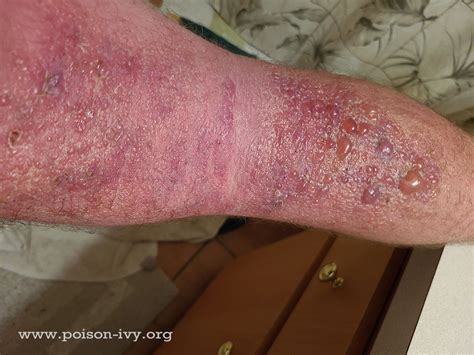 Show Me Poison Ivy Rash