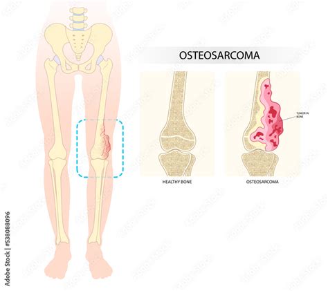 Medical Anatomy Leg Bone Pain Of The Ewings Sarcoma Tumor Cell With