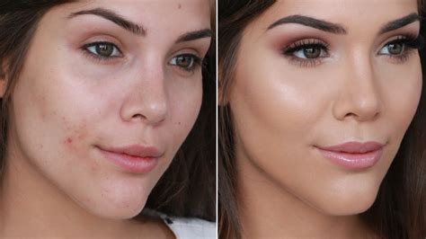 How To Cover Your Acne Without Makeup Makeupview Co