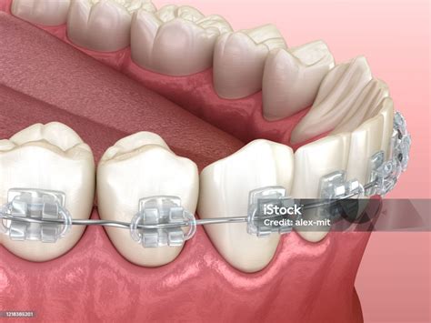 하악턱 과 클리어 브레이스 의학적으로 정확한 치과 3d 일러스트레이션 개념에 대한 스톡 사진 및 기타 이미지 개념 구별하기 힘든 도예 Istock