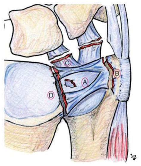 Lesiones Del Complejo Del Fibrocartílago Triangular Tipos De Reparación Revista Española De