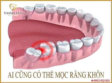 Răng Khôn Mọc Ngầm Trong Xương Nếu Không Nhổ Có Hại Gì