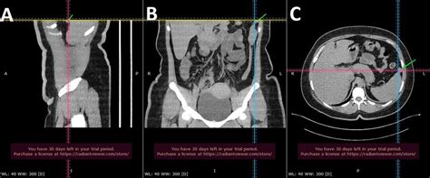 Abdomen Computerized Axial Tomography Without Contrast Computed Axial