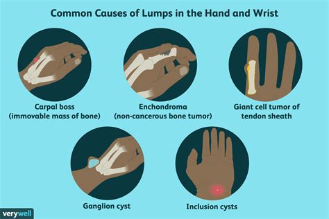 What Can A Lump On Your Arm Mean At Roger Marino Blog