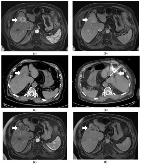 Interventional Radiology Locoregional Therapies For Intrahepatic