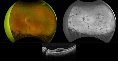 Silverstone Proliferative Diabetic Retinopathy Rg Af Oct