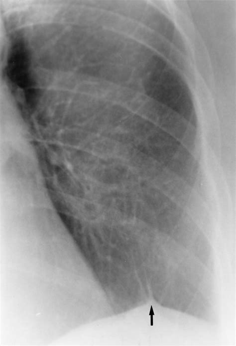 Prevalence Of The Juxtaphrenic Peak After Upper Lobectomy Ajr