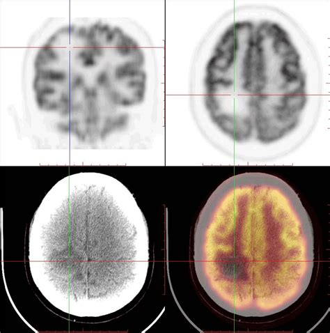 Cerebral Metastasis With 18 F Fdg Uptake Deficiency From Non Small Cell Lung Cancer