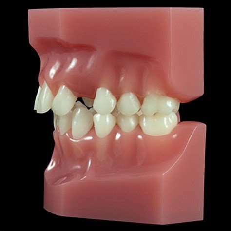Or 17m Mixed Dentitionclass Ii Division 1 Blocked Cuspid Flexibase