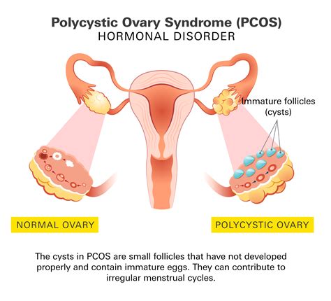 Pcos Symptoms And Treatment Manage Your Condition