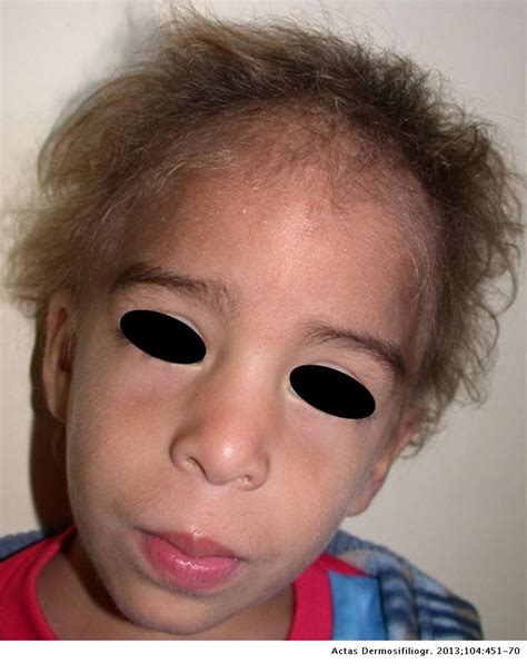Congenital Ectodermal Dysplasia