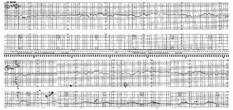 Instrumentation And Artifact Detection Including Fetal Arrhythmias Thoracic Key