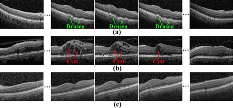 Sd Oct B Scans Of The Retina Showing Amd Dme And Normal Volumes A Amd Download Scientific