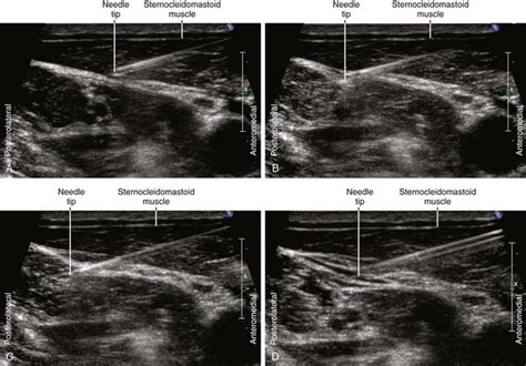 Cervical Plexus Block Radiology Key