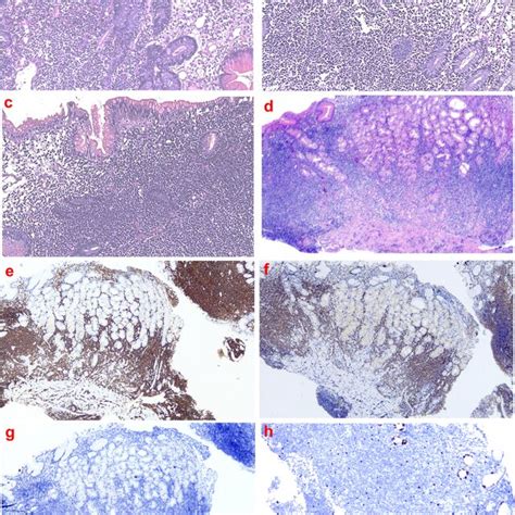 Representative Photomicrographs Of Four Times Colon Biopsies Of Patient Download Scientific