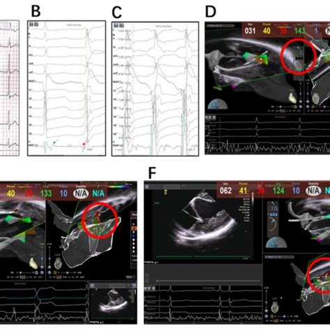 A Representative PVC Body ECG Of APM B ECG Of Sinus Rhythm And Download Scientific Diagram