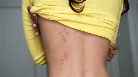 Bed Bug Bites Triangle How To Spot Treat And Stop Them Now