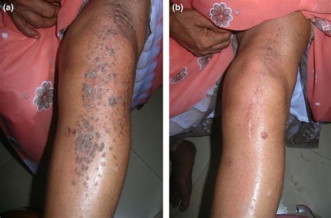 How To Get Rid Of Dermatitis Neglecta Naturally Kadovik