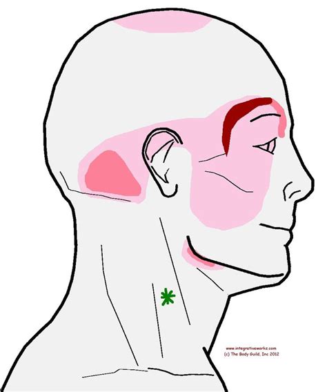 36 Best Headache Trigger Point Pain Images On Pinterest Trigger 36 Best Headache Trigger Point Pain Images On Pinterest Trigger