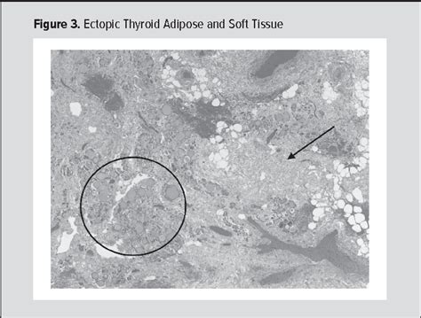 Figure 3 From Ectopic Thyroid Tissue With Hashimotos Thyroiditis Semantic Scholar