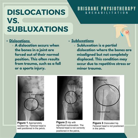 Dislocations Vs Subluxations Brisbane Physiotherapy And Podiatry