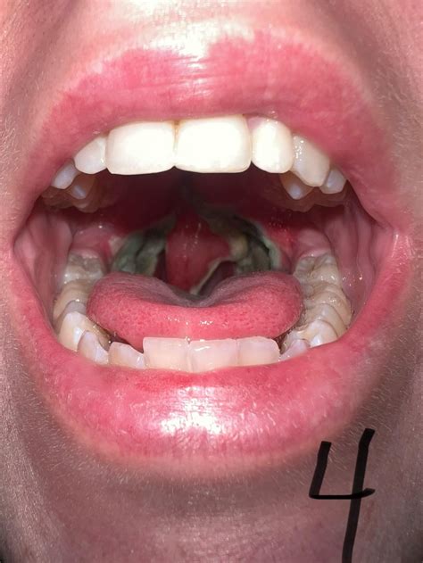 Tonsillectomy Recovery With Pictures R Tonsilstones