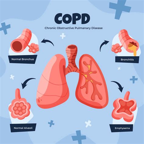 Chronic Obstructive Pulmonary Disease Copd Causes Symptoms Diagnosis And Treatment Daily