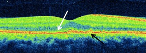 Spectral Domain Optical Coherence Tomography Sd Oct Of The Right Eye Download Scientific