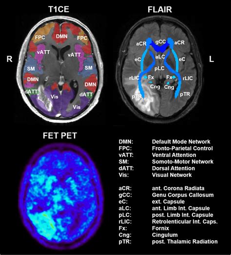 Principles Of Lesion Mapping Demonstrated In A Patient With A Right