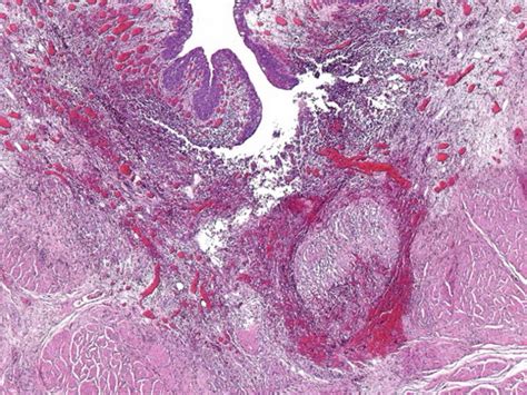 Інтерстиціальний цистит причини симптоми діагностика лікування