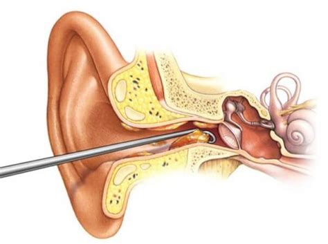What Is Ear Wax And How Is Earwax Buildup Removed Ear Wax Removal
