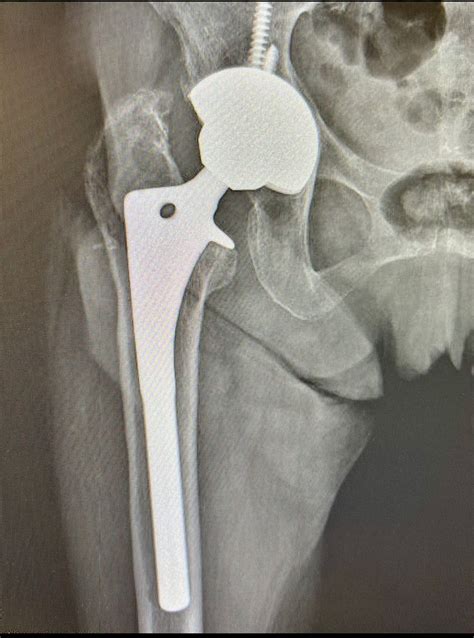 Orthopedics Orthopedicsurgeon Orthopedicsurgery Medicaldevicesales Watson Extraction System