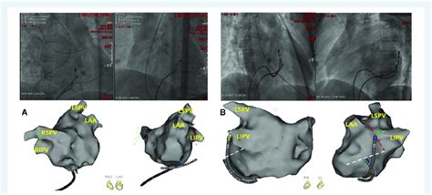 Position Of The Ablation Catheter From The Ostium To Distal End Of The