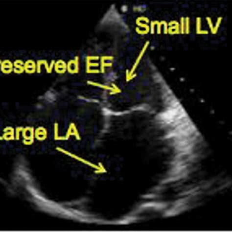 Right Ventricle Echocardiography Download Scientific Diagram