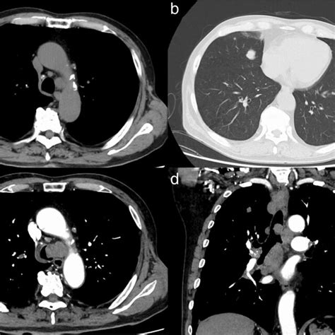 Chest Computed Tomography Ct On The Initial Visit And Admission A