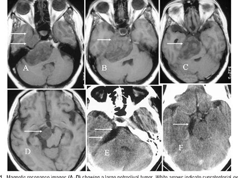 Figure 1 From Obsessive Compulsive Disorder And Cingulotomy Semantic Scholar