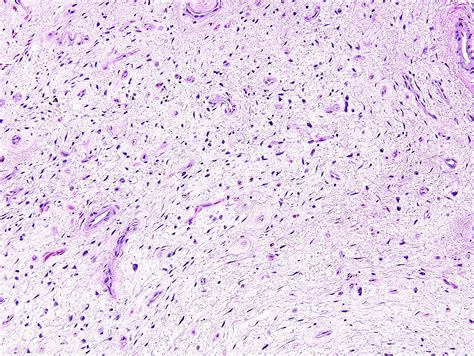 Myxoid Neoplasms Surgical Pathology Clinics