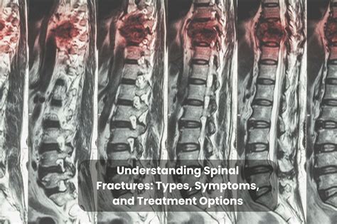 Understanding Spinal Fractures Types Symptoms And Treatment Options Spine Surgeon