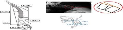 Radiographic Characteristics Of Cervical Deformity Cd Usin