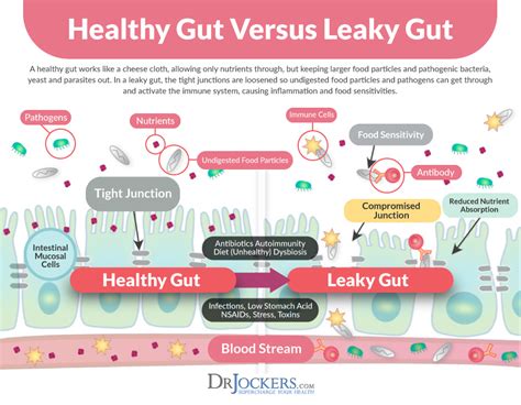 Ulcerative Colitis Causes Symptoms And Natural Support Strategies